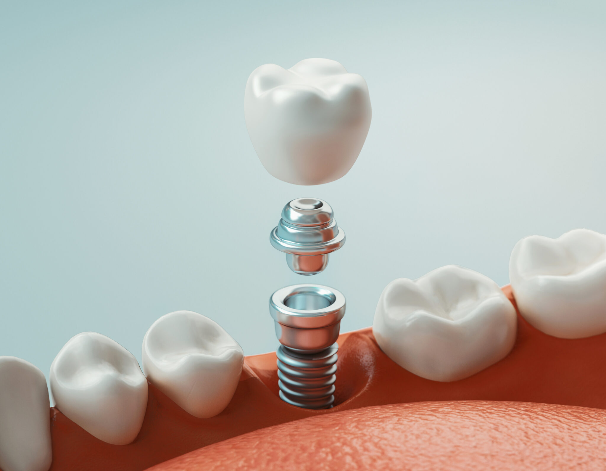 Dental Implants vs. Bridges: What’s Best for Huntington Beach Patients ...